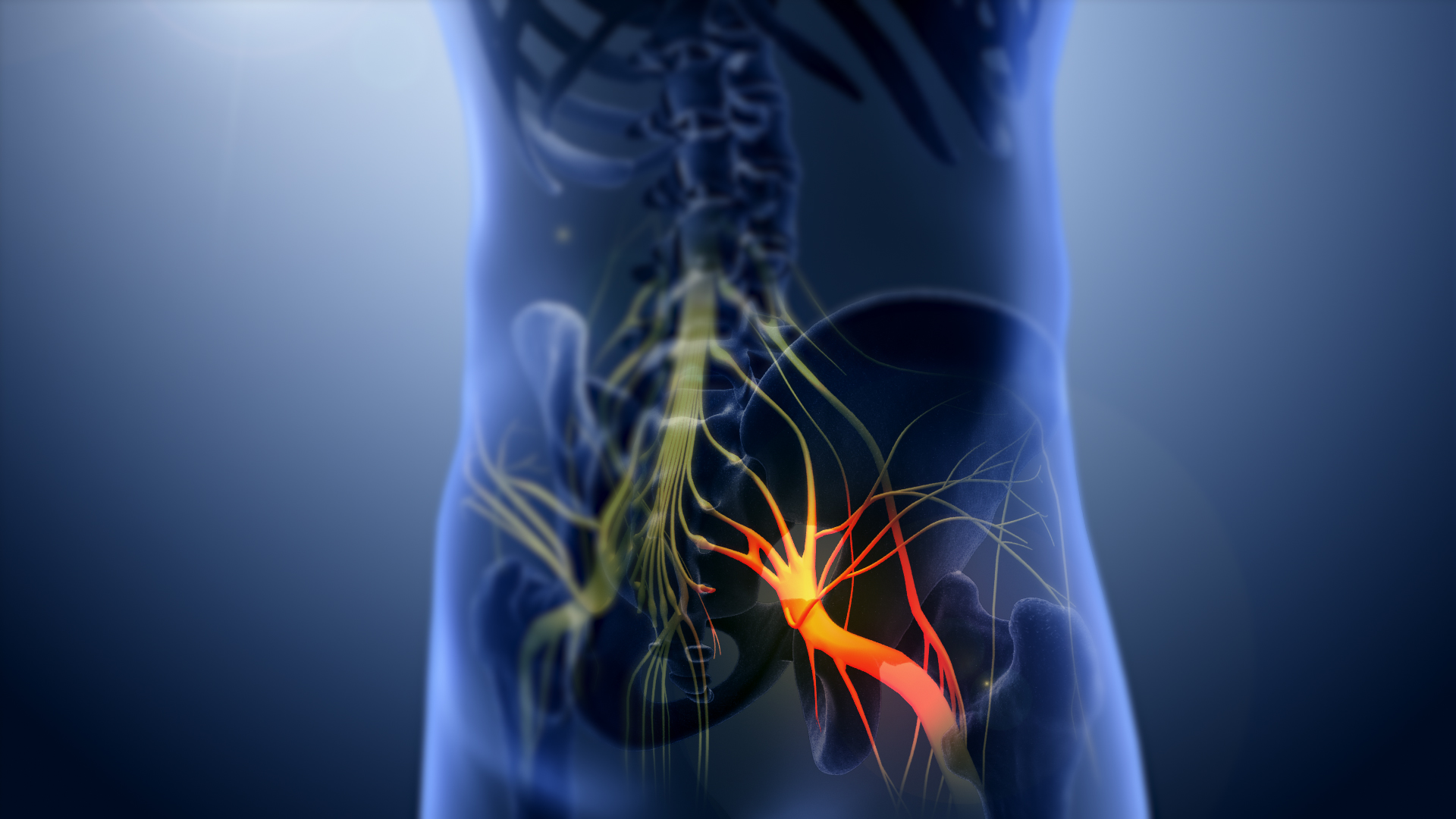 A Guide to Sciatica: Causes, Symptoms, Diagnosis, Treatment, and ...